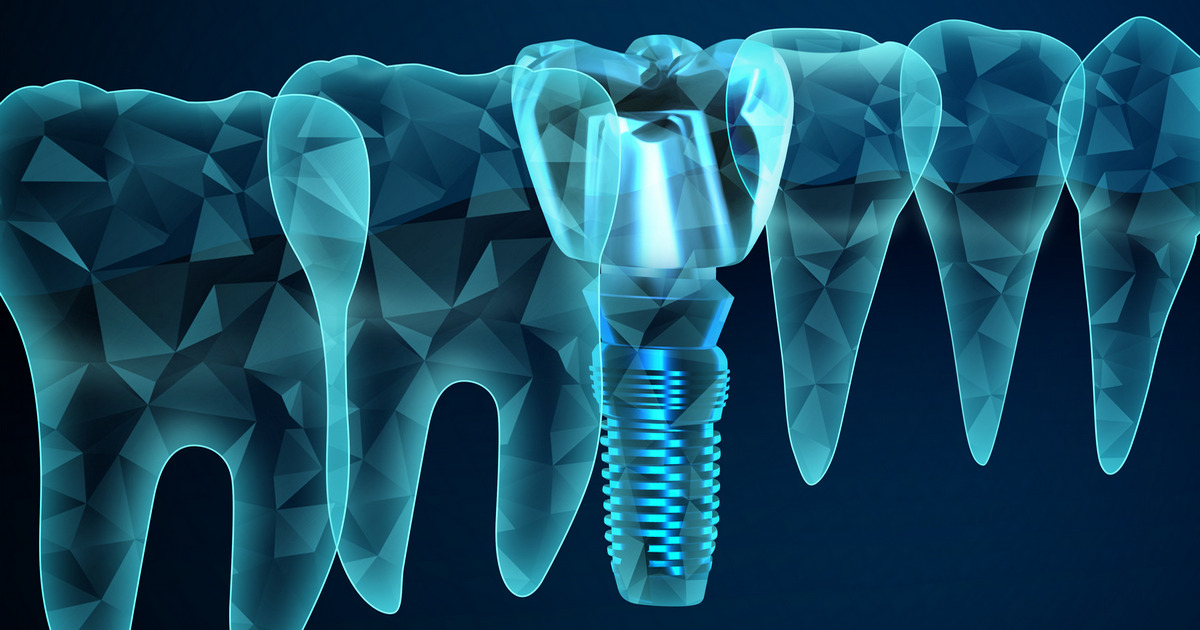 Neues von exocad: DentalCAD 3.1 Rijeka vereinfacht Designprozesse ...